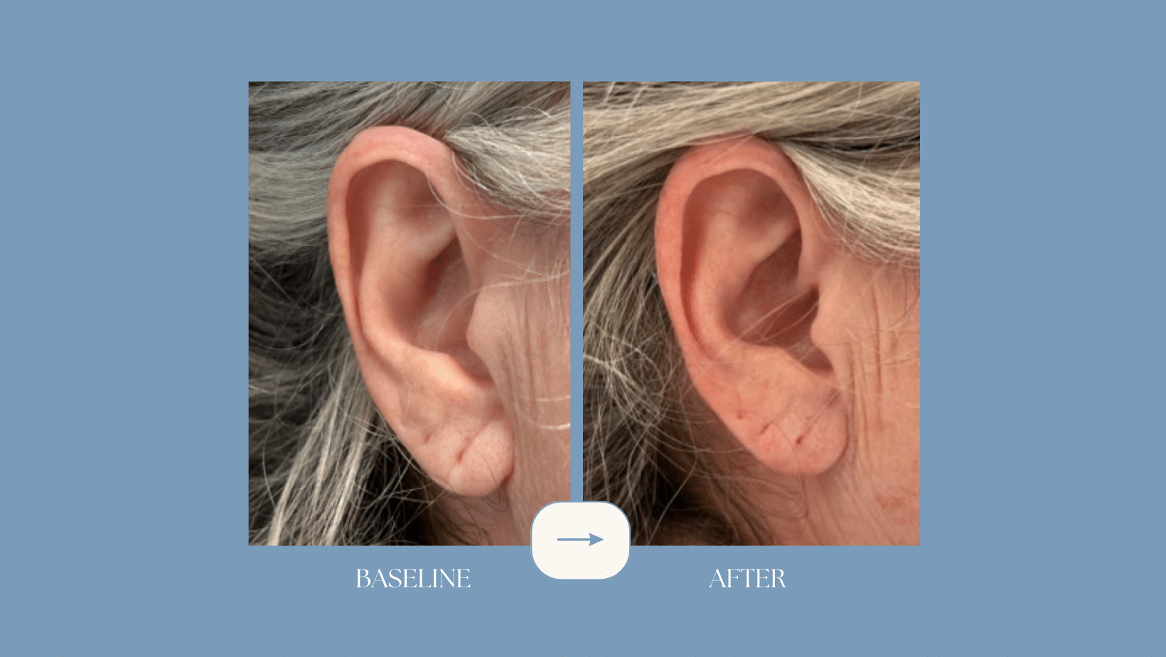 THE ART OF EARLOBE REJUVENATION WITH FILLERS