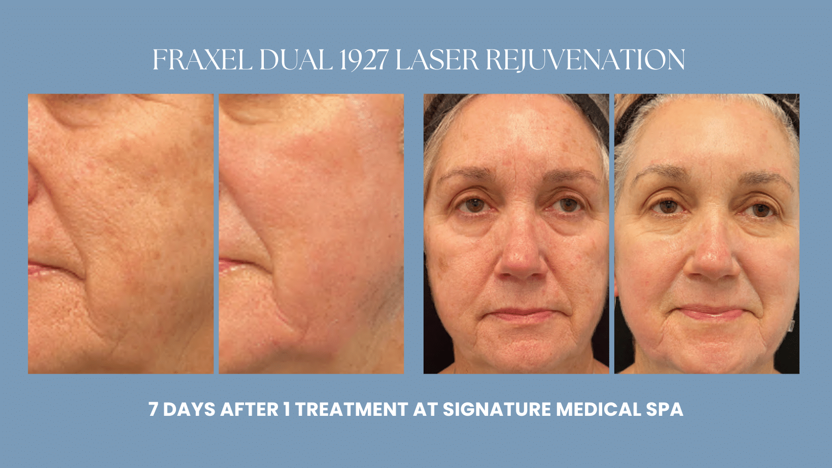 RESULTS AFTER ONE WEEK WITH FRAXEL DUAL 1927