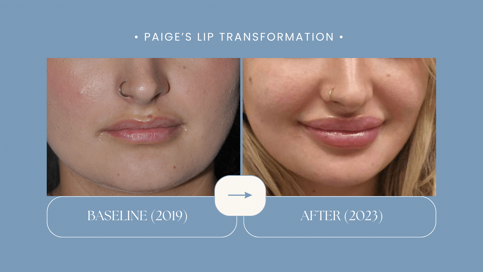 THE ART OF ACHEIVING YOUR PERFECT POUT